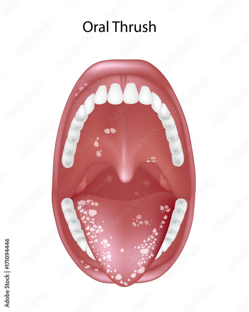 Oral thrush, candidiasis Stock Illustration | Adobe Stock