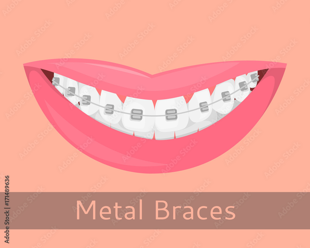 Dental braces, smiling lips in cartoon style isolated. Smile with ...