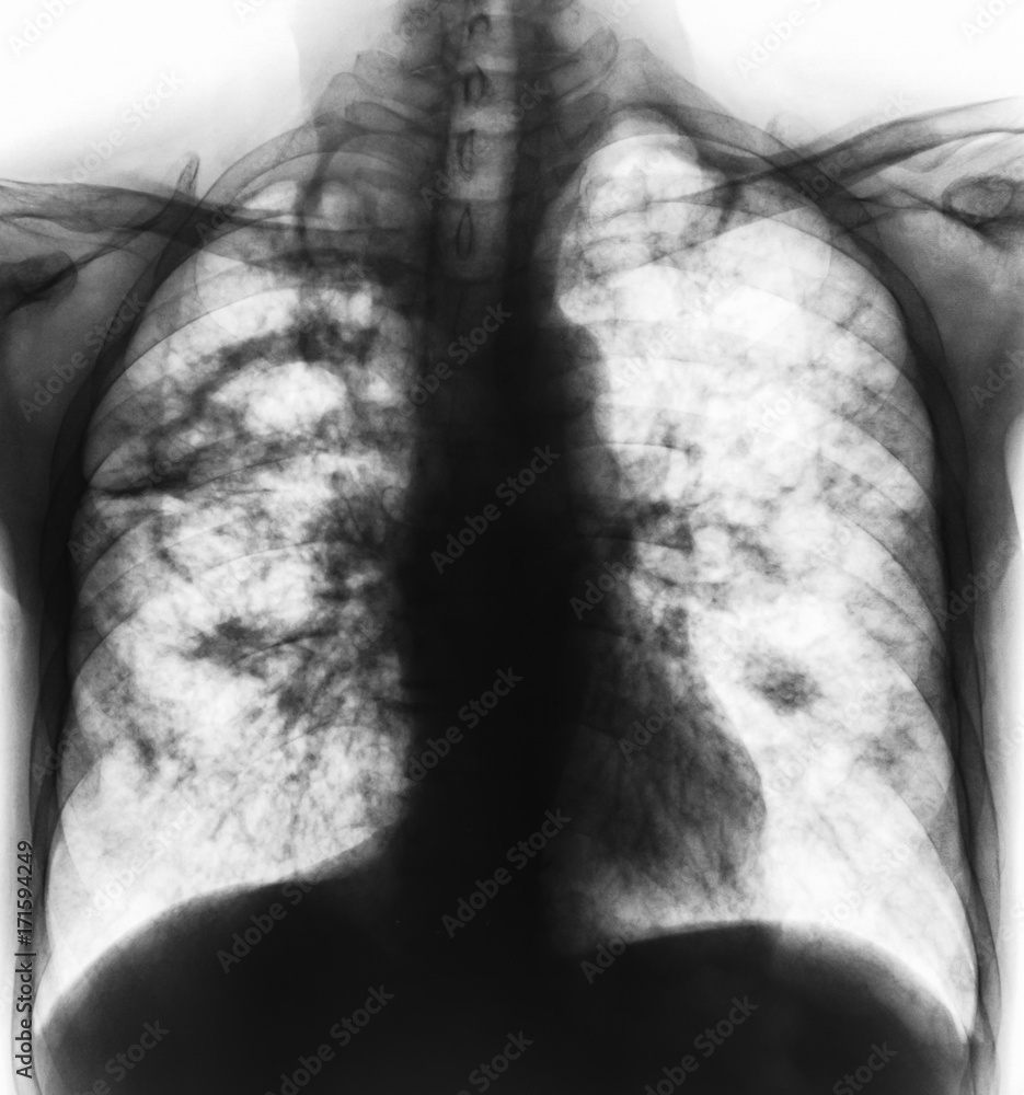Pulmonary tuberculosis . Film x-ray of chest show cavity at right lung ...
