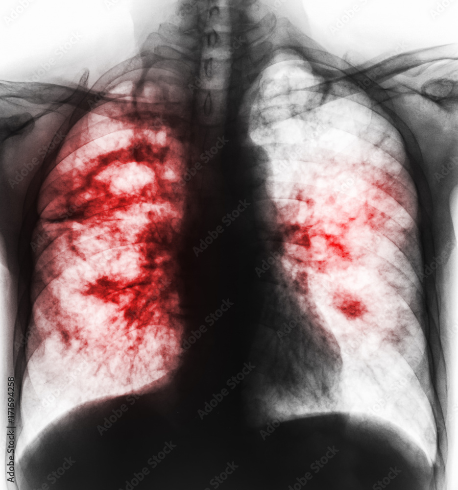 Pulmonary tuberculosis . Film x-ray of chest show cavity at right lung ...