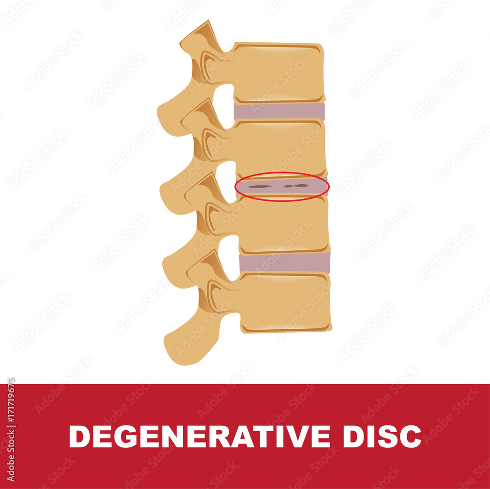 human disc degeneration. degenerative disc vector illustration Stock ...