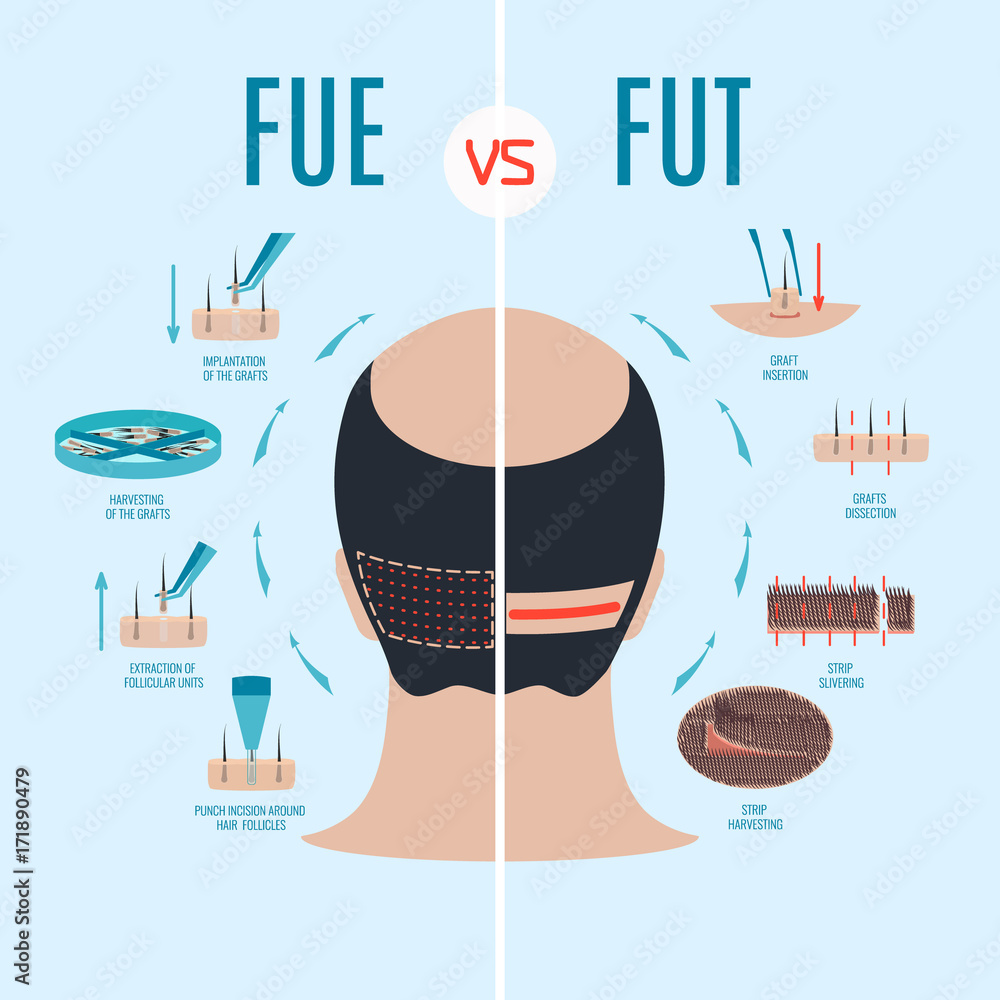 Fue Vs Fut Follicular Unit Extraction Versus Follicular Unit