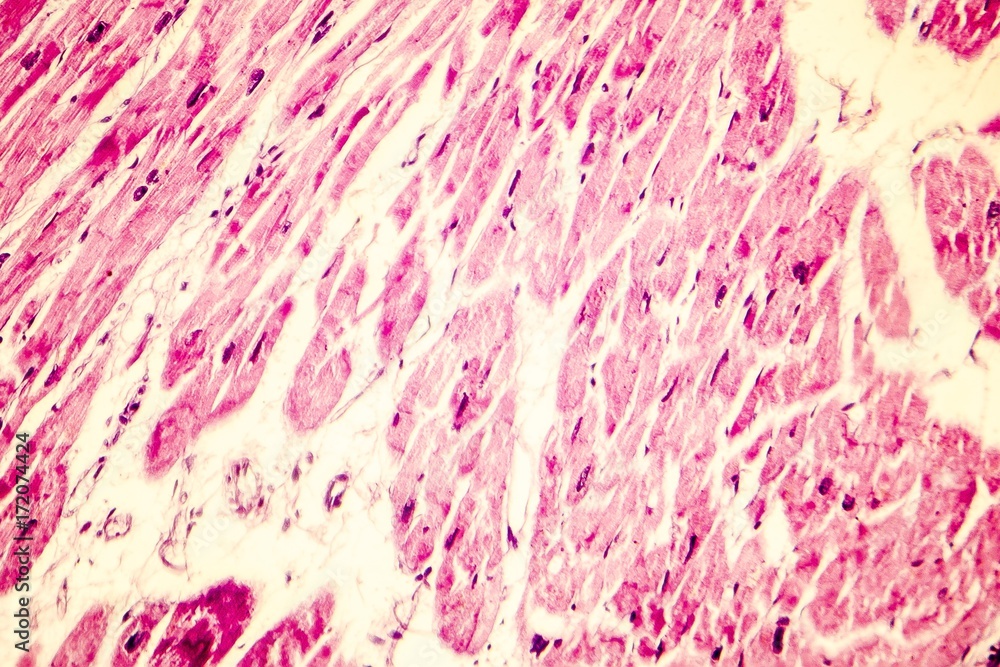 Heart hypertrophy. Photomicrograph showing hypertrophic myocardium with ...