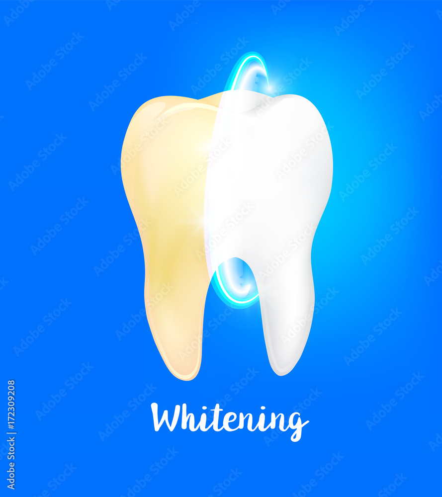 Cleaning dirty tooth on blue background, clearing tooth process. Tooth ...