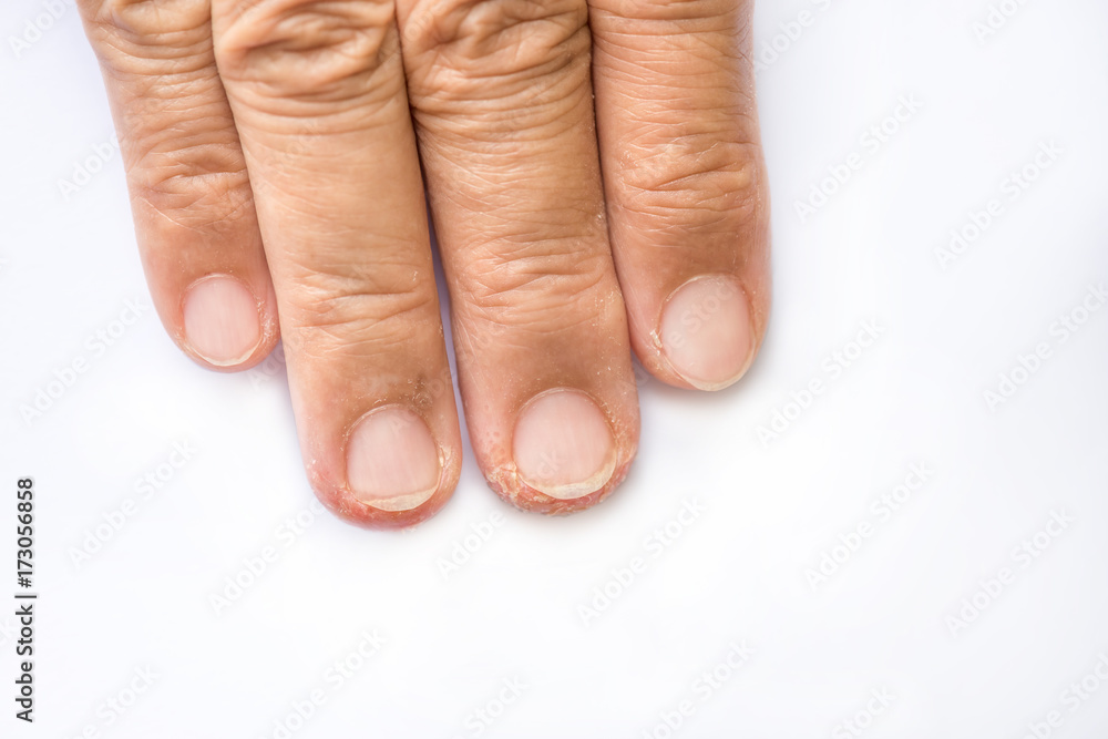 Advanced stage of dyshidrosis on fingers,cracked and peeling skin ...