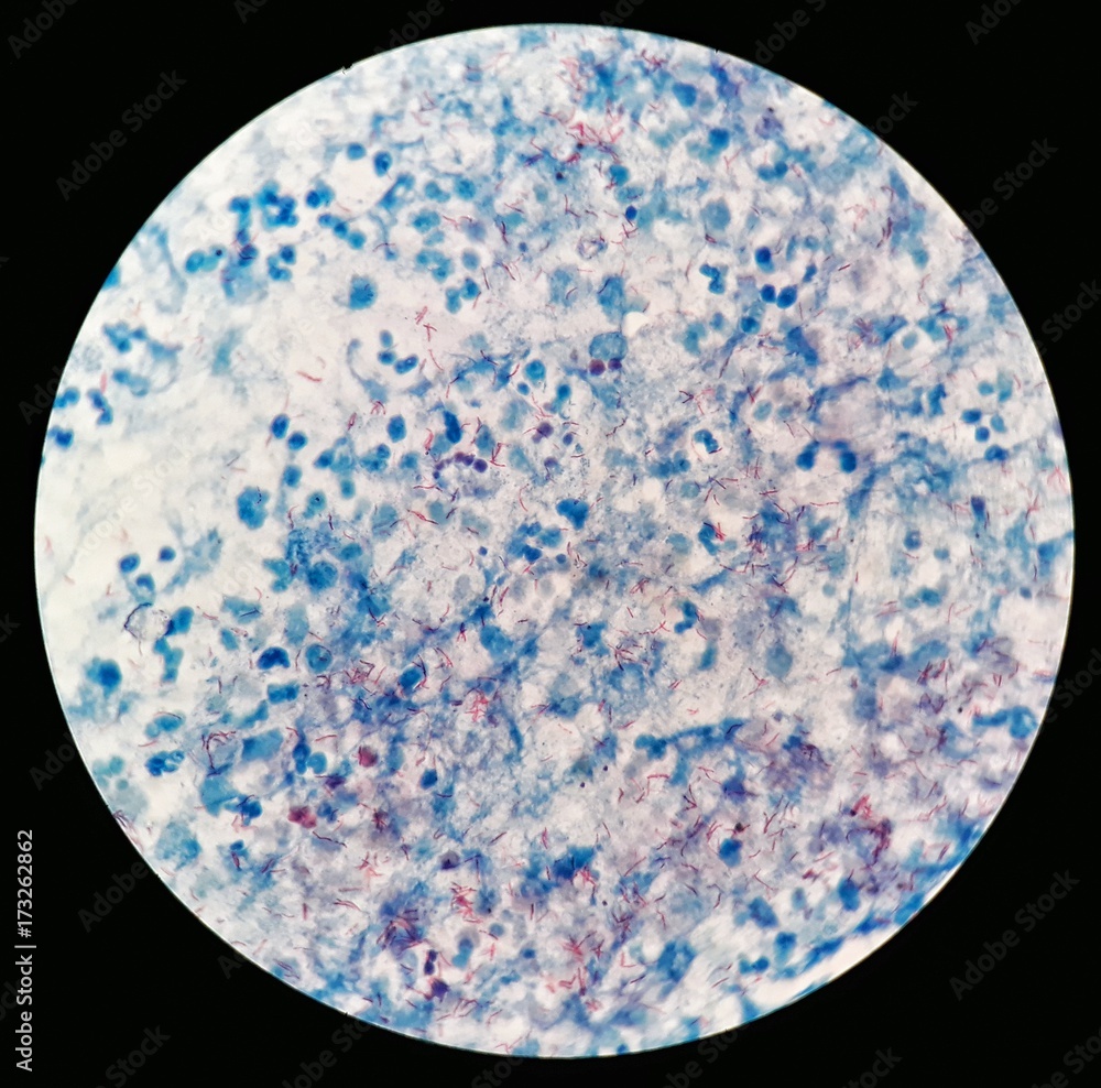 Smear of Acid-Fast bacilli (AFB) stained from human body fluid specimen ...