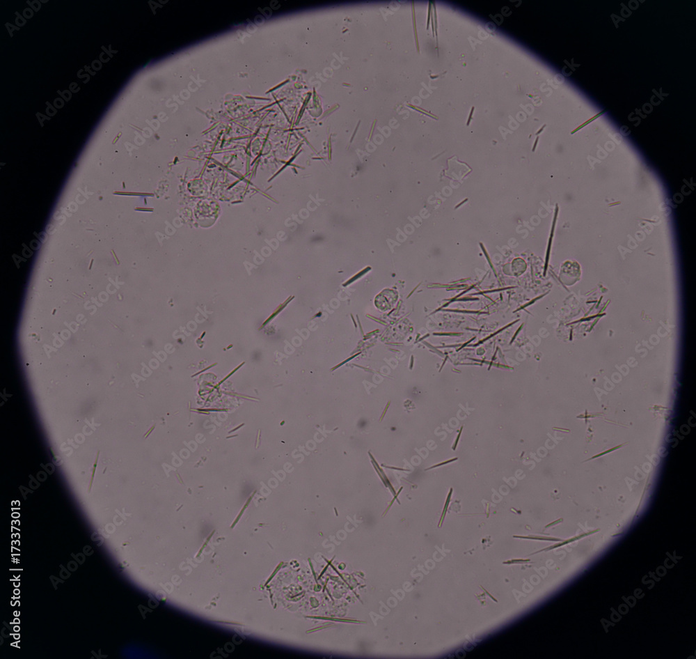 Moderate Uric acid crystal needle shape.. Stock Photo | Adobe Stock