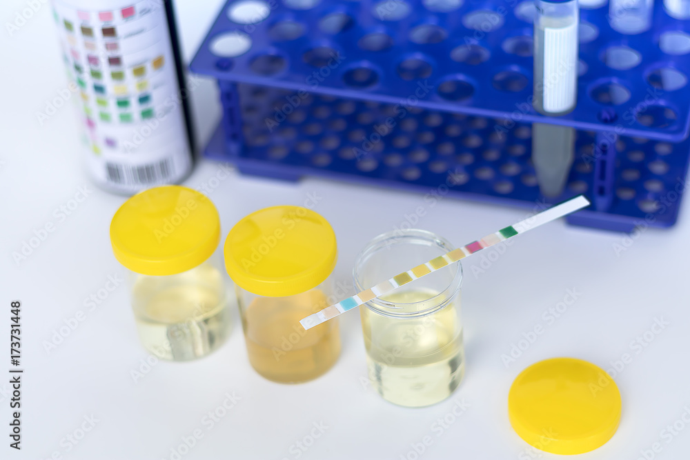 Reagent Strip for Urinalysis, Routine Urinalysis, urine test analysis ...