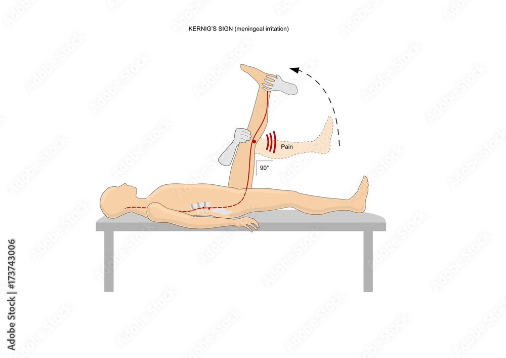 Kernig's sign, a neurological test to evaluate a meningeal irritation ...