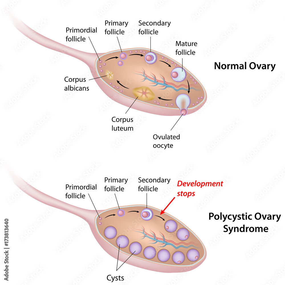 Polycystic ovary syndrome, labeled. Stock Illustration | Adobe Stock