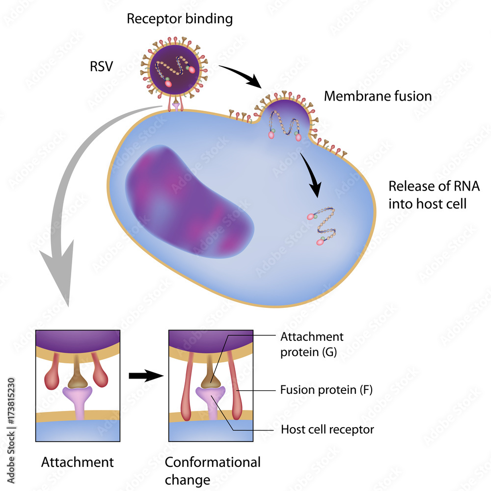 Respiratory syncytial virus (RSV) infection, labeled. Stock ...