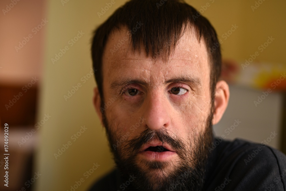 homme trisomique foto de Stock | Adobe Stock