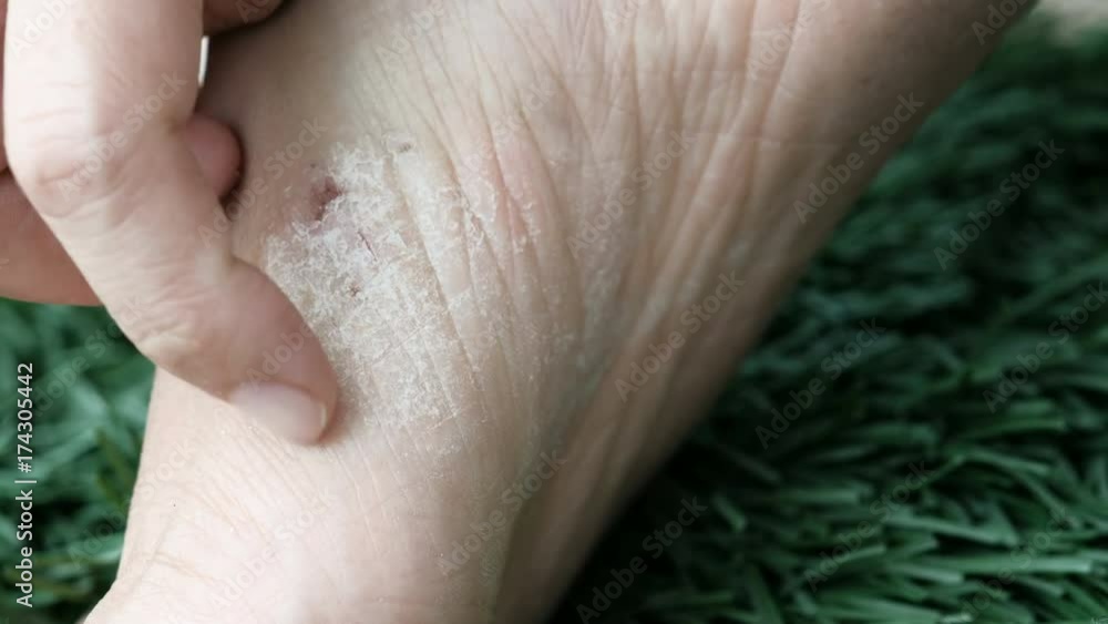 4K footage of Person scratching skin, Psoriasis on the foot shows ...