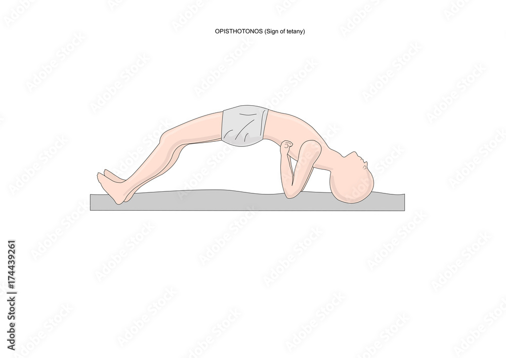 Opisthotonos, or muscle spasm, in a boy with tetanus, a disease caused ...