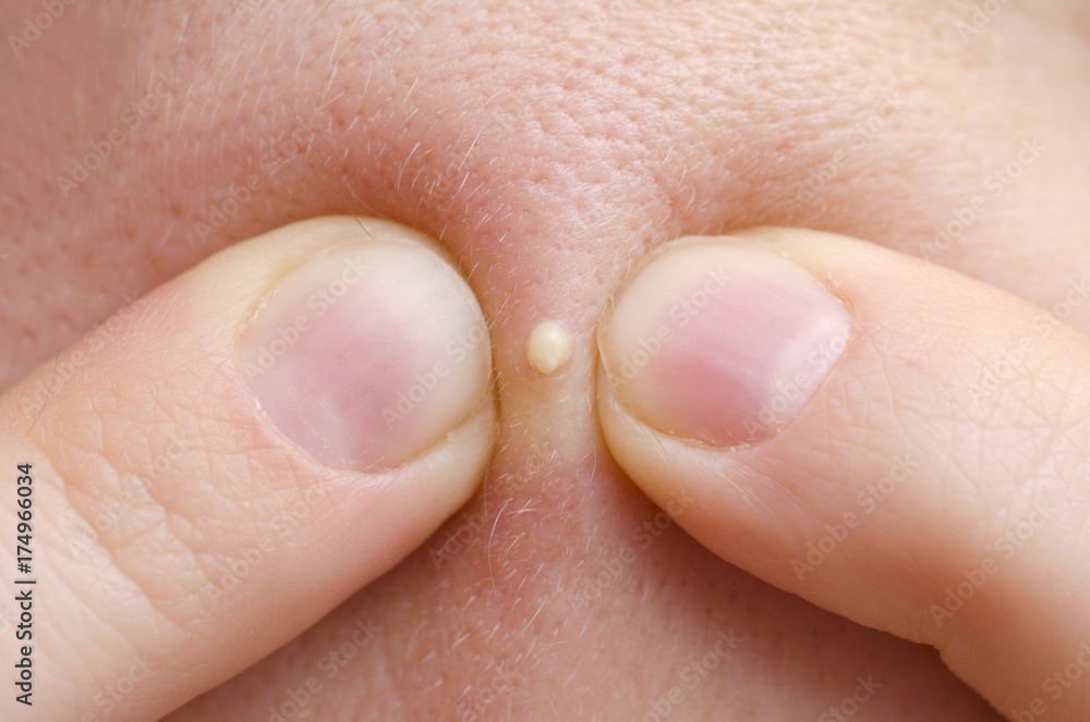 Squeezing Pimple Macro Stock Photo Adobe Stock squeezing-pimple-macro-stock-photo-adobe-stock