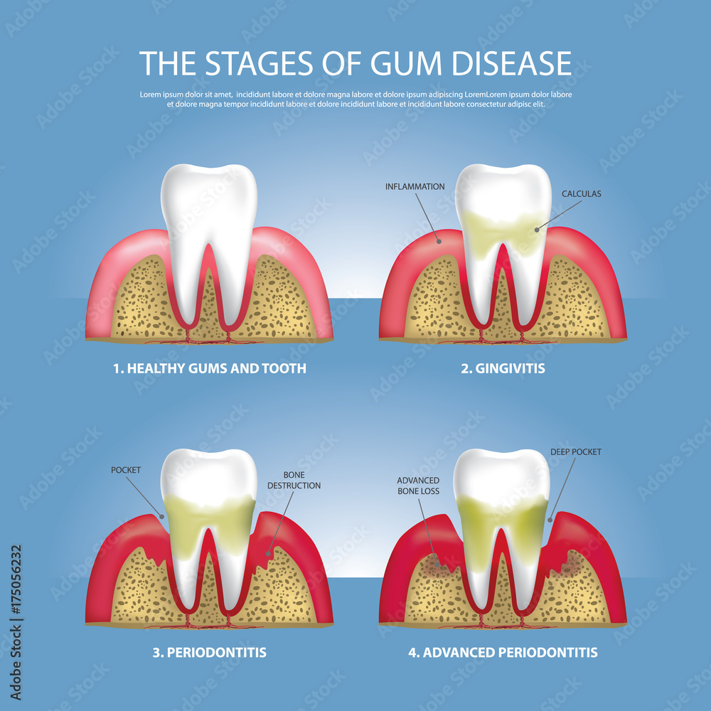 Human teeth Stages of Gum Disease Vector Illustration Stock Vector ...