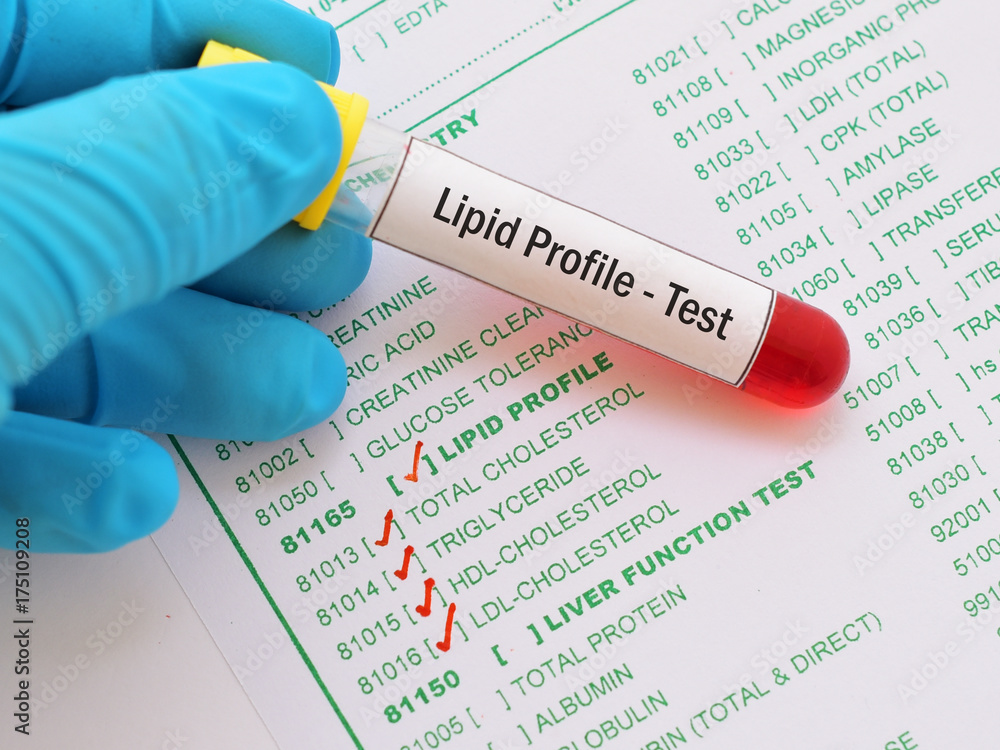 Blood sample with requisition form for lipid profile test Stock Photo ...