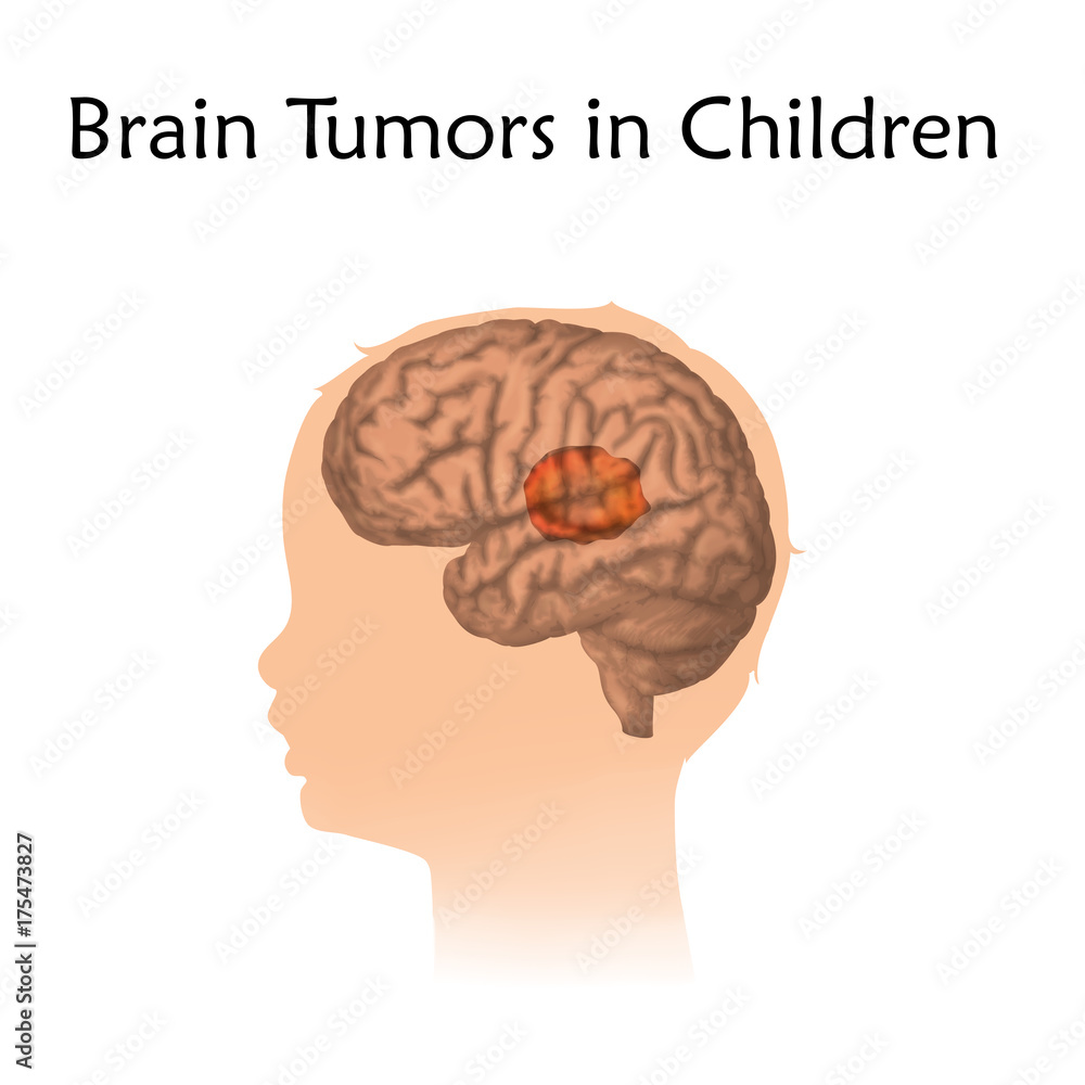 1613333 Brain tumors, cancer in infants, childhood. Vector medical ...