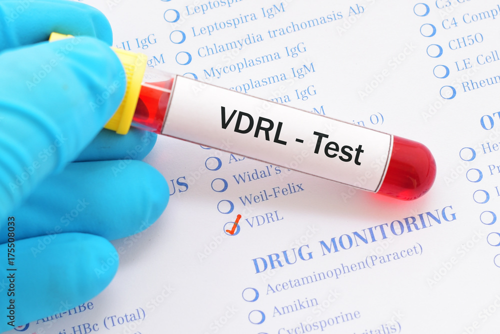 Blood sample with requisition form for VDRL test, diagnosis for ...