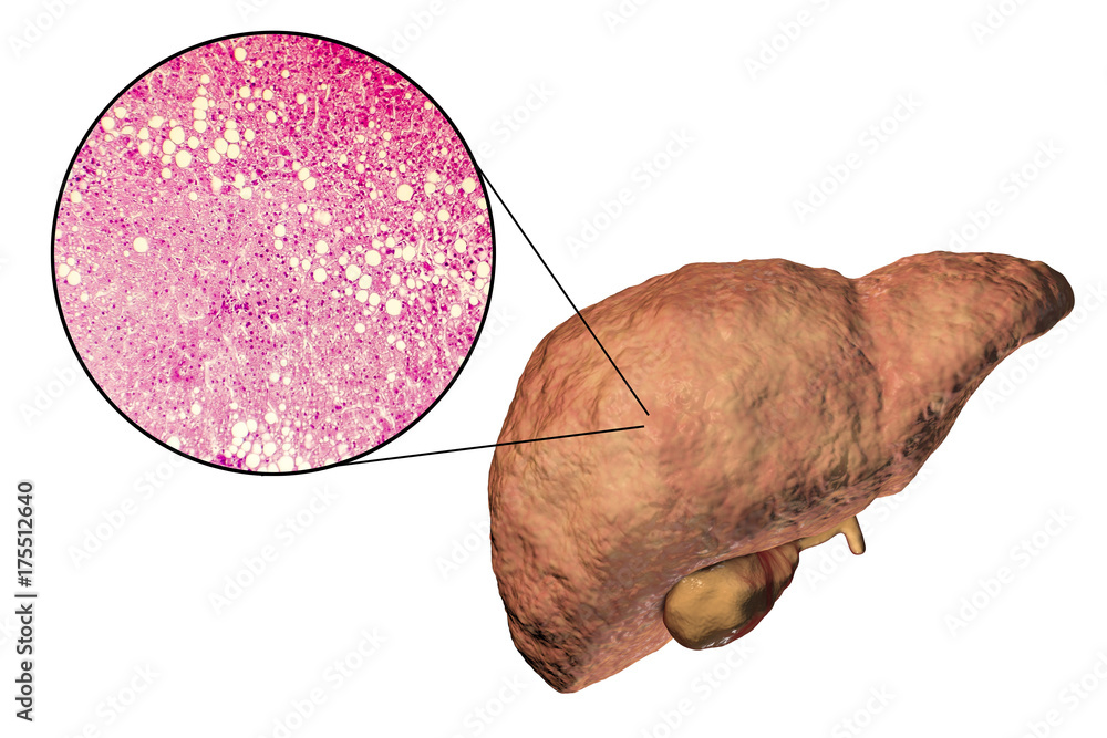 Fatty liver, liver steatosis, 3D illustration and photomicrograph ...