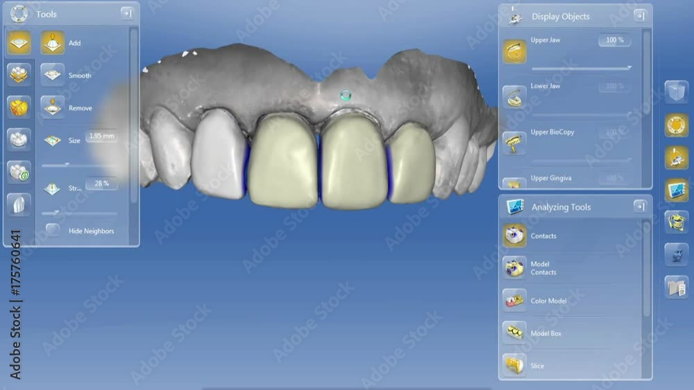 Stockvideo Creating and designing Porcelain Veneer installation ...