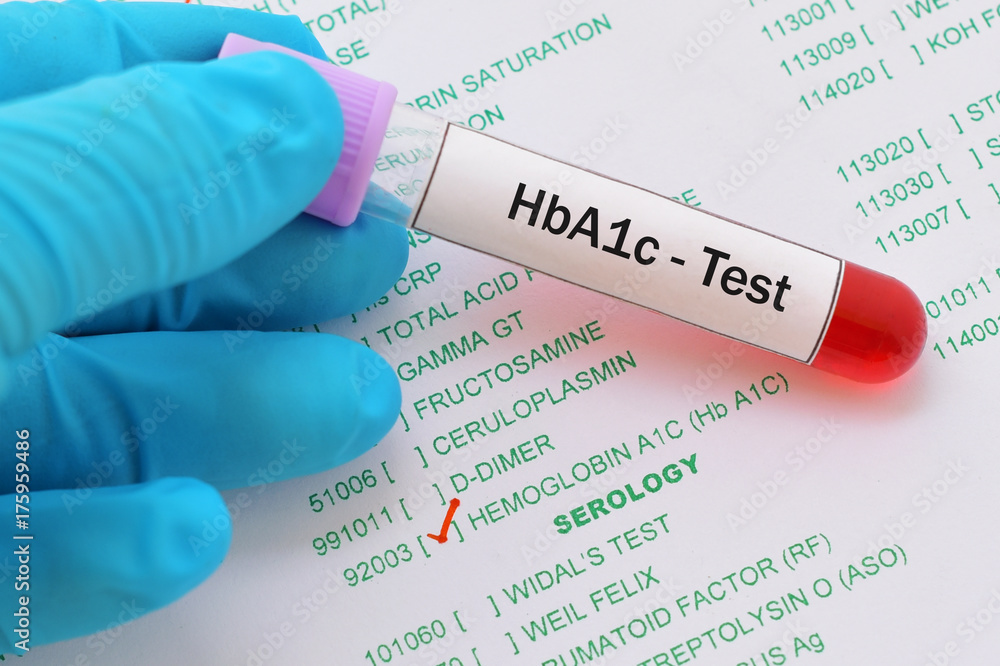 Blood sample with requisition form for HbA1c test Stock Photo | Adobe Stock