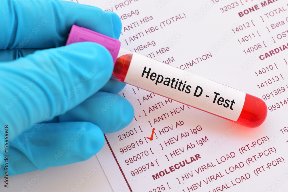Blood sample with requisition form for hepatitis D virus (HDV) test ...