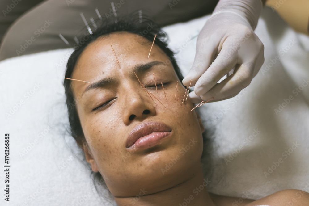 Asian women 40 years old acupuncture acupuncture on face to maintain ...