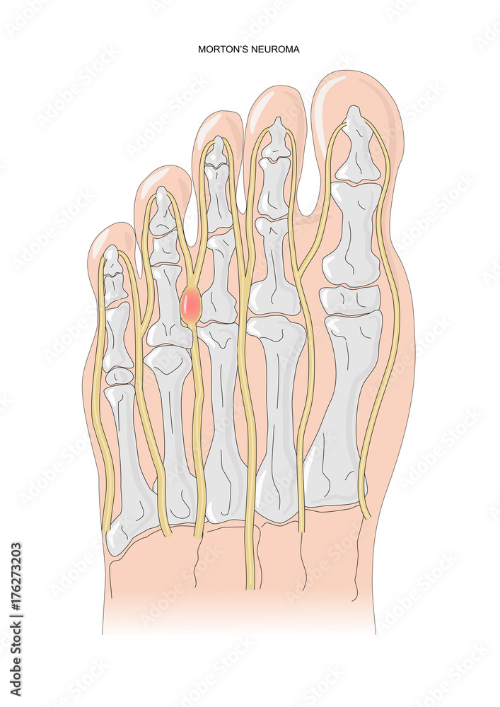 Morton's neuroma, or Morton metatarsalgia, a benign tumor of plantar ...