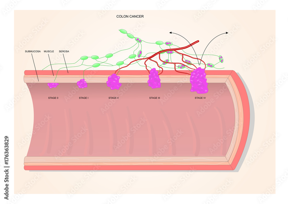 colon cancer in its various stages, according to the TMN system Stock ...