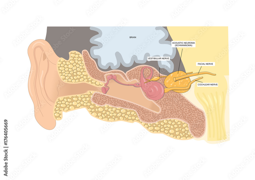 acoustic neuroma, or neurinoma, or vestibular schwannoma, a benign ...