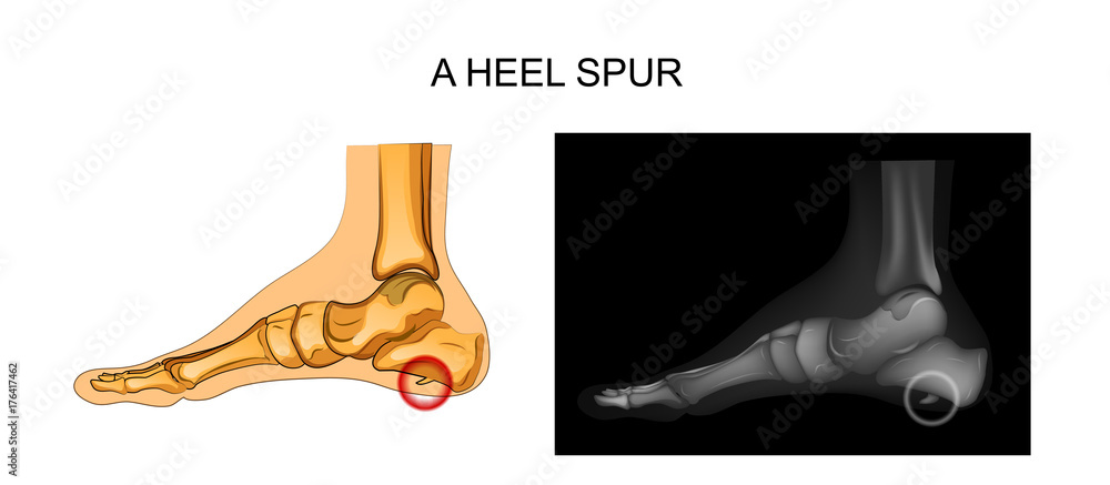 Retrocalcaneal Spur
