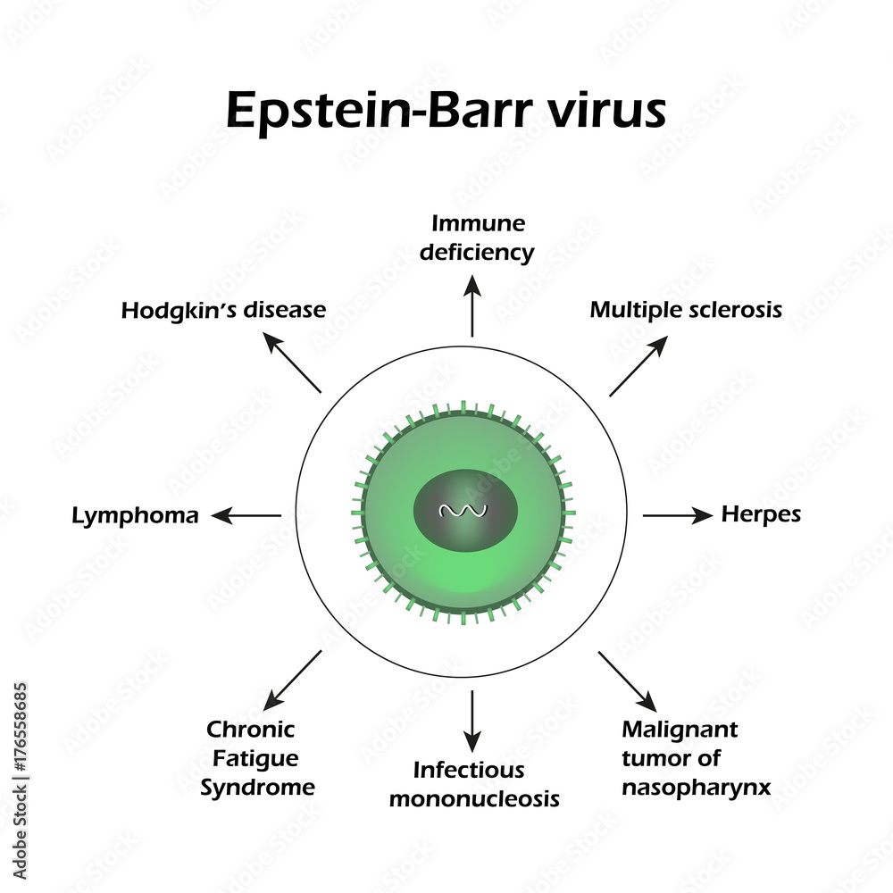 Epstein-Barr virus. Diseases caused by a virus. Infographics. Vector illustration Stock Vector ...