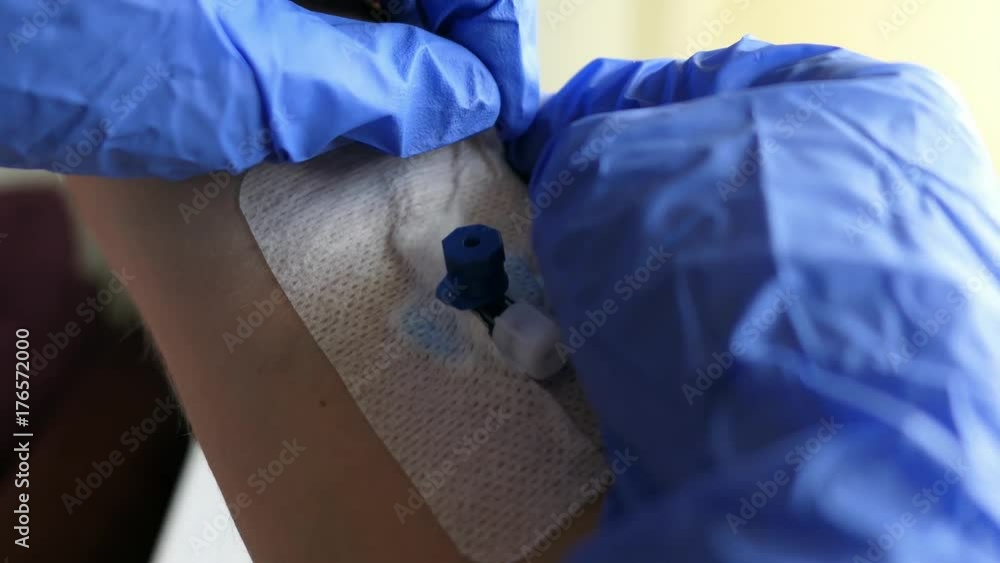 Nurse Removing Intravenous Catheter From Patient's Arm Stock Video ...