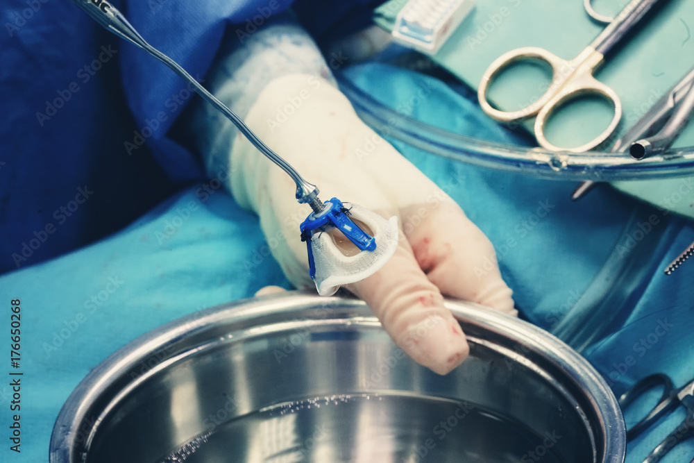 Team of surgeons minimally invasive aortic valve surgery replacement ...