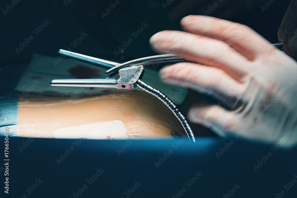 cannula and aorta is cross clamping using special flexible aorta clamp ...
