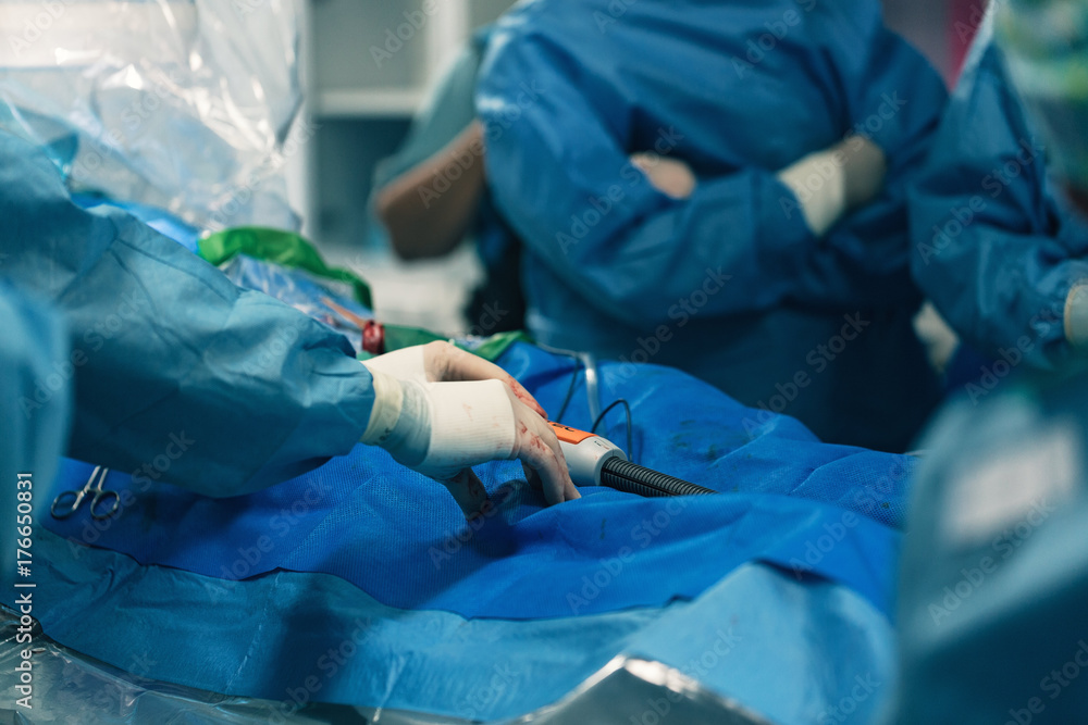 Interventional cardiologist surgeon do AAA endovascular treatment stent ...