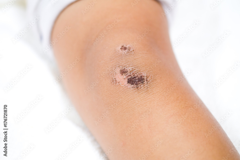 wound scab of a child's knee on a white background Stock Photo | Adobe ...