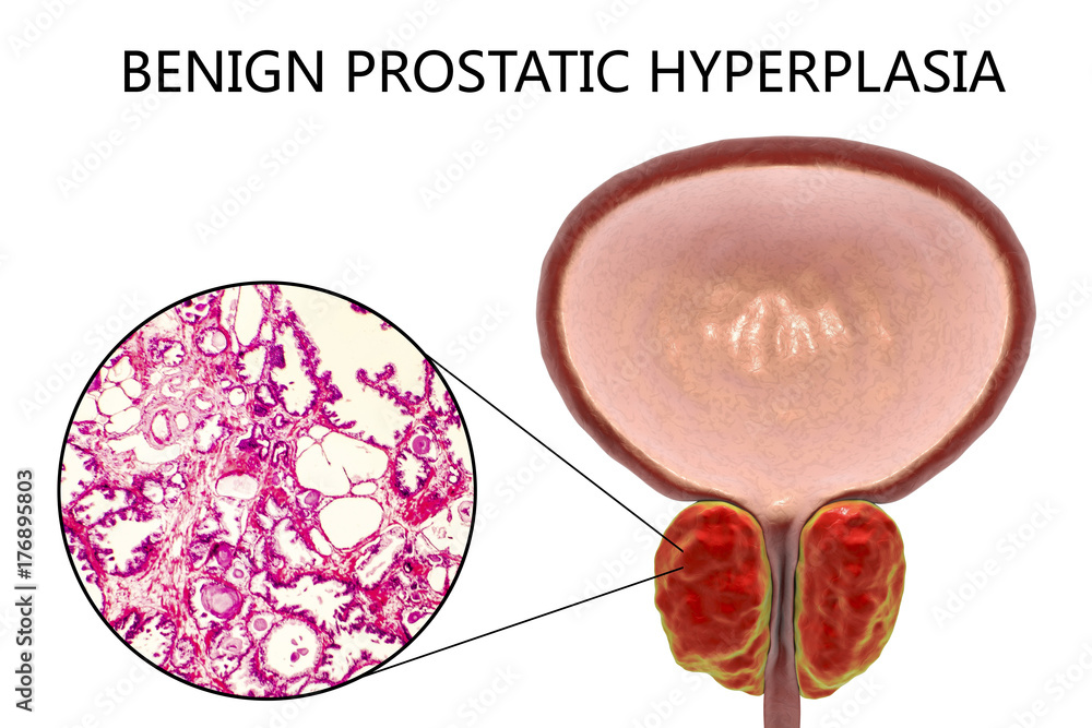 Benign prostatic hyperplasia, 3D illustration showing enlarged prostate ...