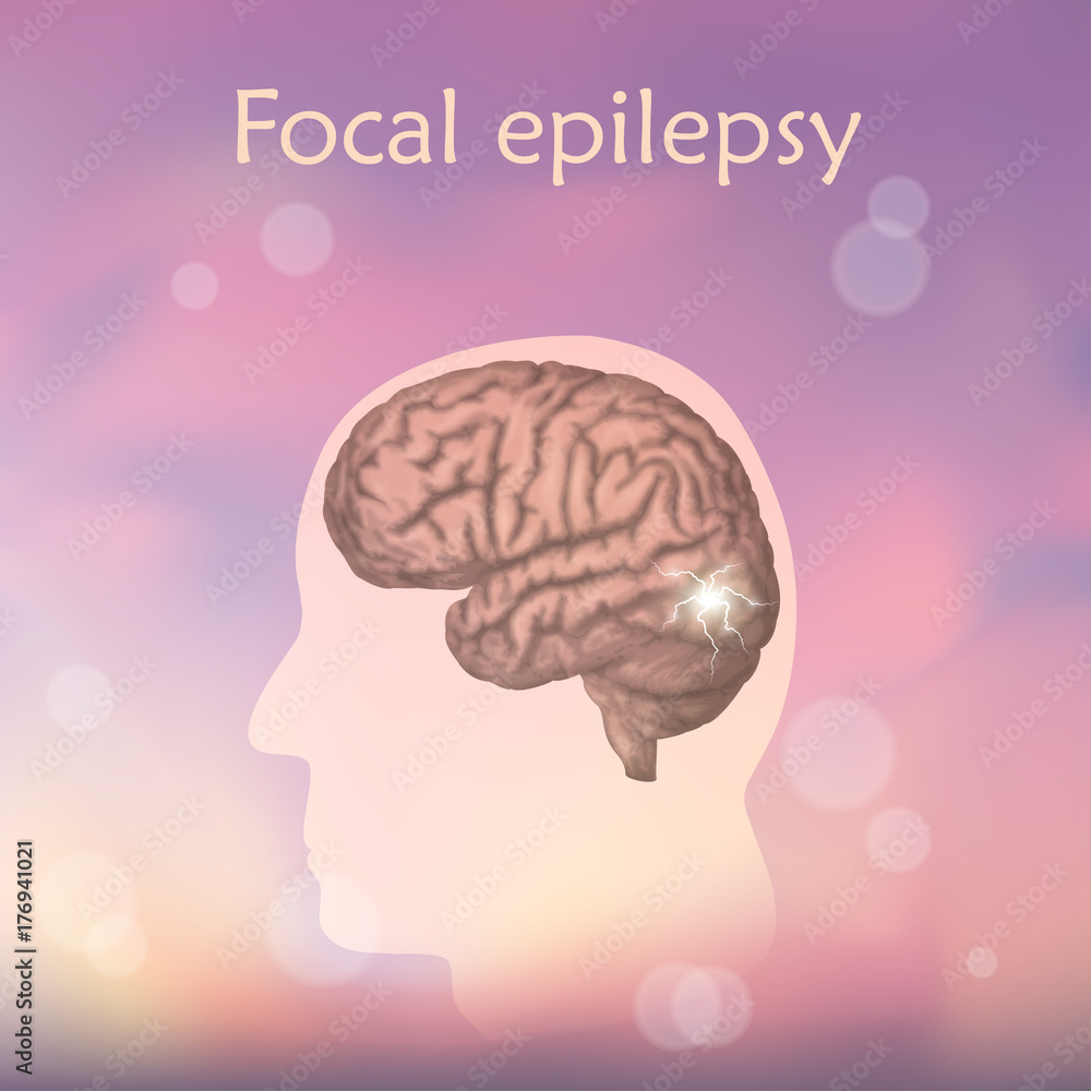 Focal epilepsy. Vector medical illustration. Blurred pink background ...