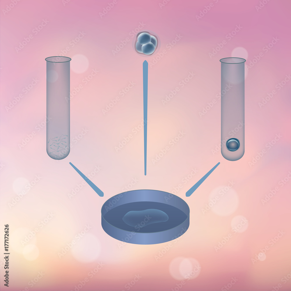 In vitro fertilization IVF . Insemination. Ovum and sperm spermatozoons ...