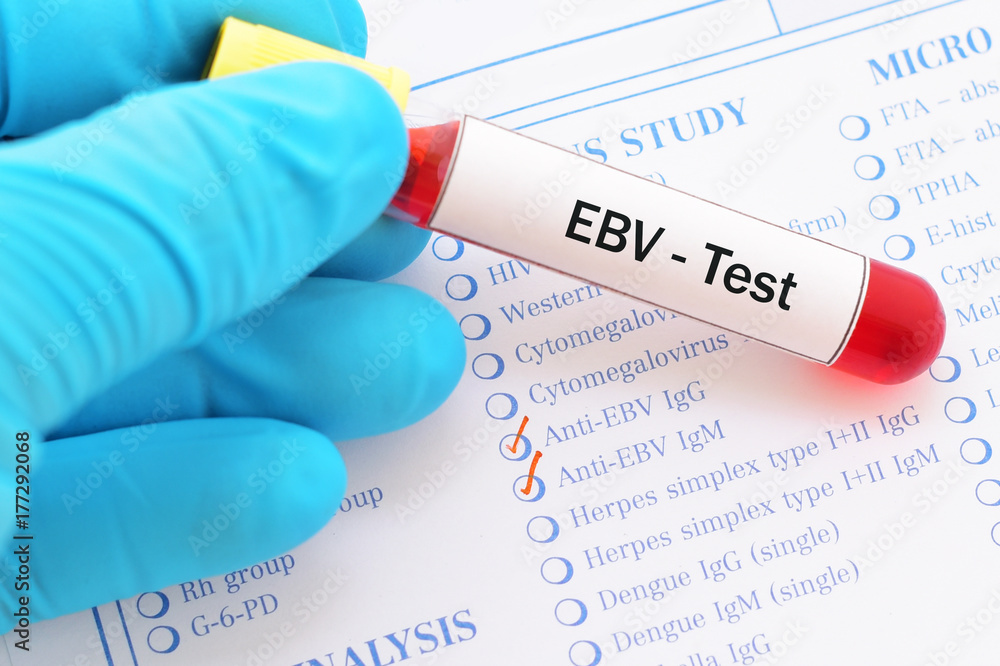 Blood sample with requisition form for Epstein-Barr virus (EBV) test ...