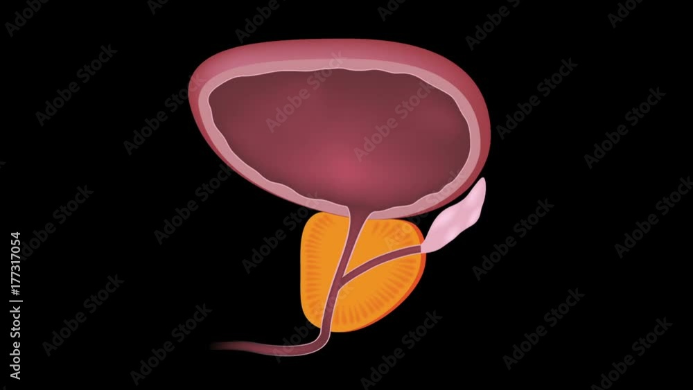 Benign prostatic hyperplasia (BPH) animation vídeo do Stock | Adobe Stock