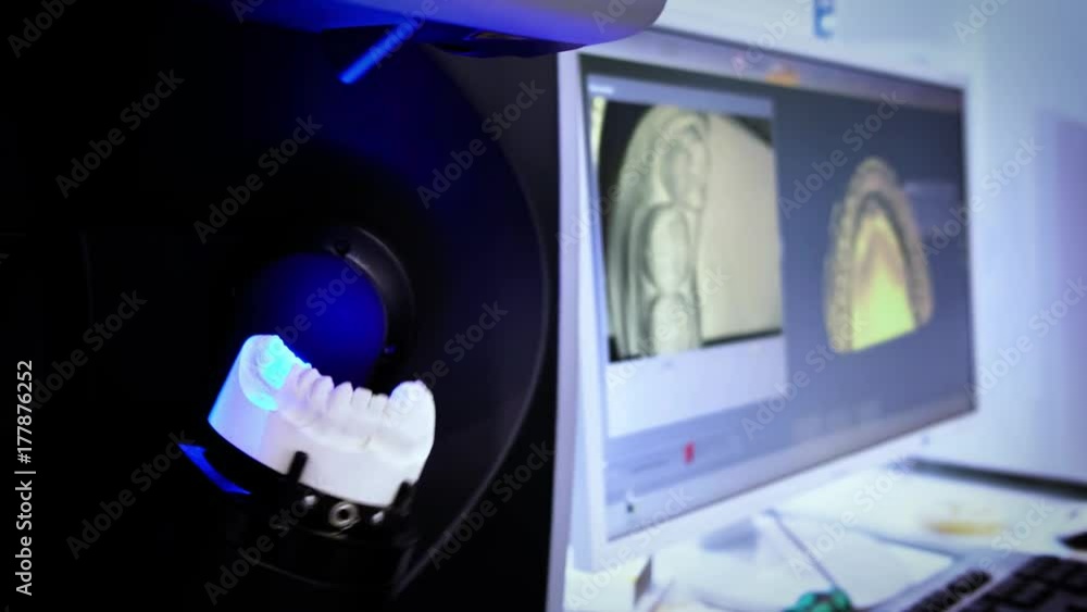 Dental prosthetic restoration. Denturist is making 3D model for ...