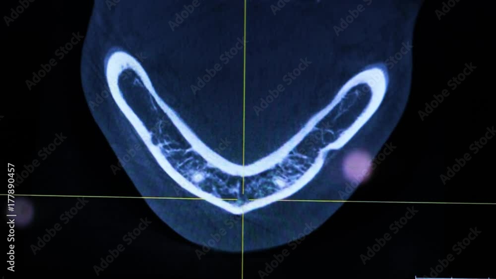 toothache symptom. X-ray of the human jaw on the computer. The doctor ...