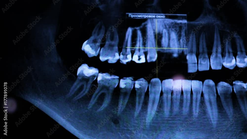 toothache symptom. X-ray of the human jaw on the computer. The doctor ...