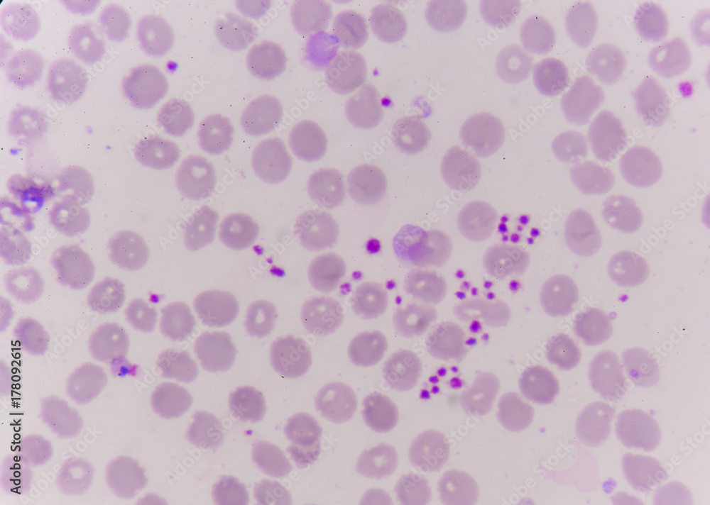 platelet clumping as a possible cause of low platelet count in patients ...