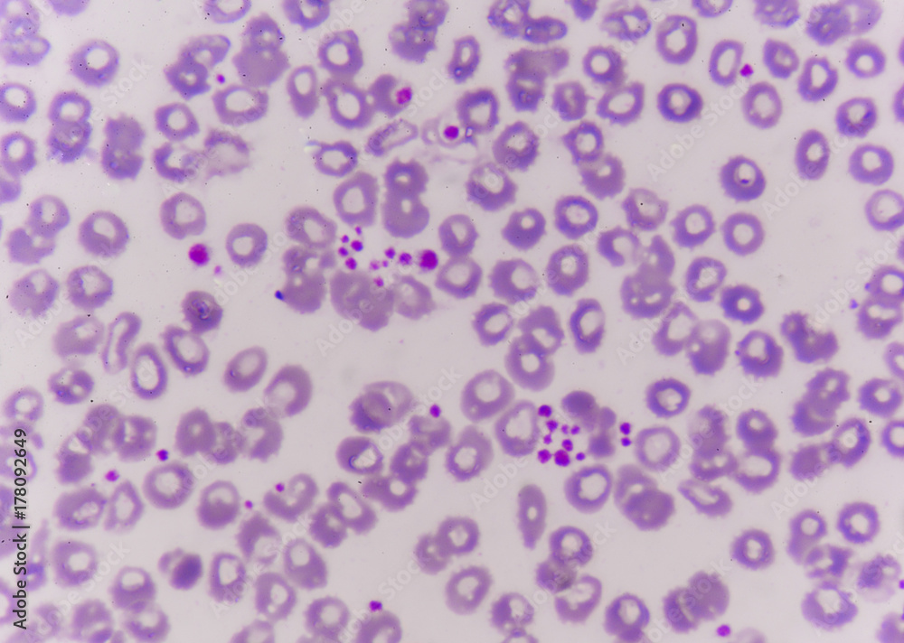 platelet clumping as a possible cause of low platelet count in patients ...