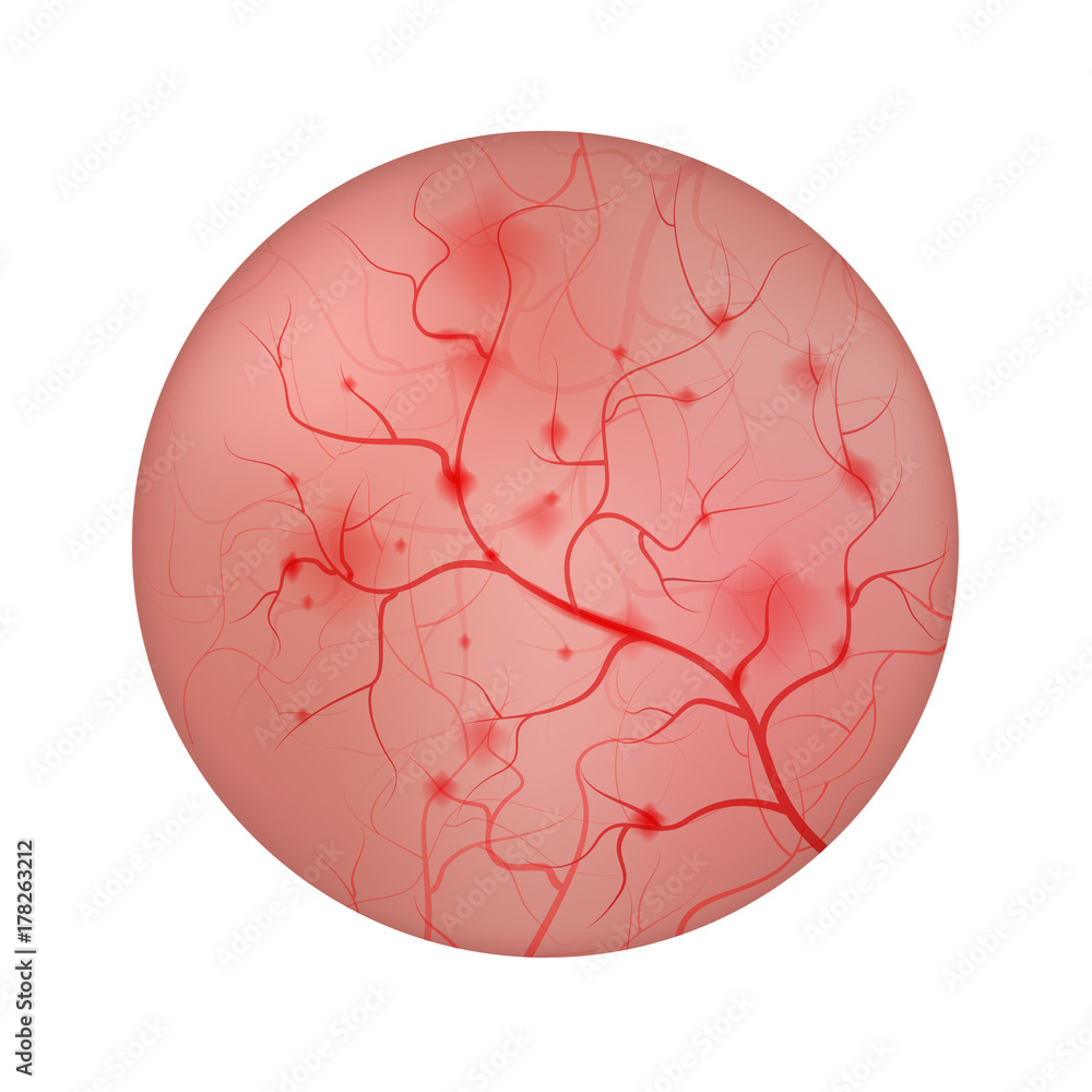 Inflammation of the urinary bladder Cystitis, interior lining closeup ...