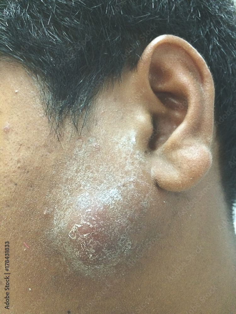 Abscess On Cheek